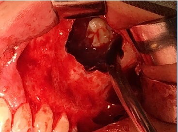 Sinusite odontogénica: cisto dentígero associado ao terceiro molar ...