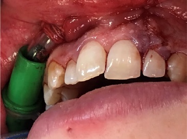 Sinusite odontogénica: cisto dentígero associado ao terceiro molar ...
