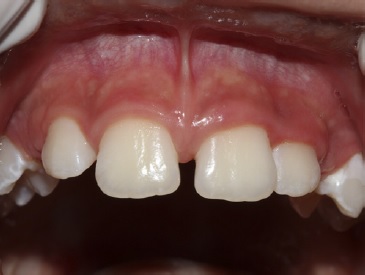 Frenectomia labial superior na dentição mista associada a diastema ...
