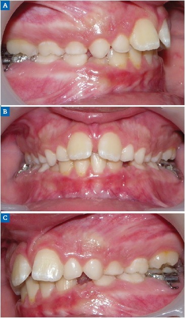 Maxillary lateral incisor agenesis and microdontia: Minimally invasive ...