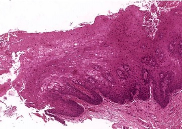 White Sponge Nevus of the oral mucosa - Case report
