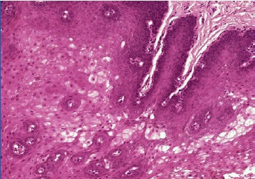 White Sponge Nevus of the oral mucosa - Case report