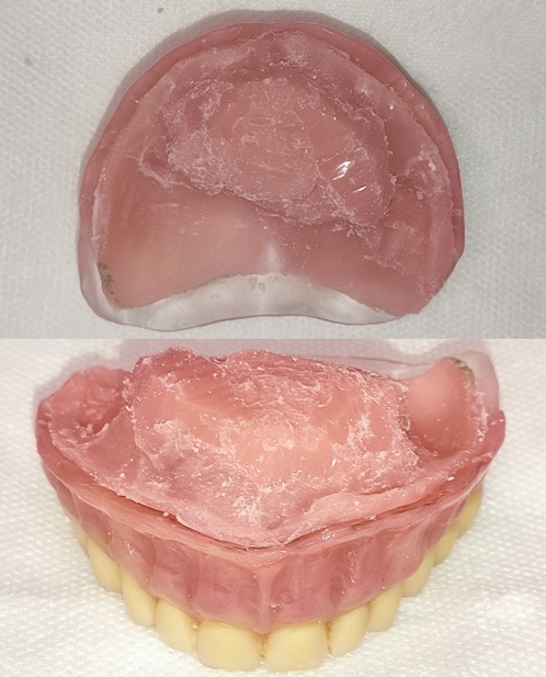 Occlusive denture for the management of medication-related ...
