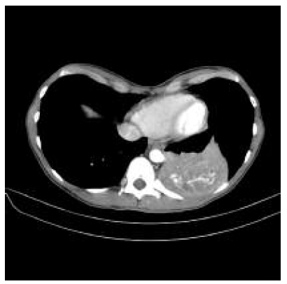 Sequestro pulmonar: um diagnóstico improvável