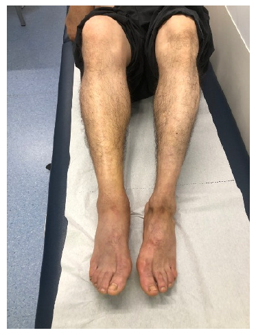 Sinal do crescente e rotura de quisto de Baker na prática clínica: um ...