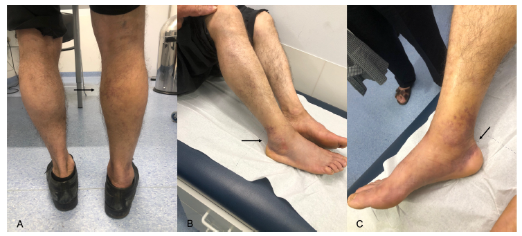Sinal do crescente e rotura de quisto de Baker na prática clínica: um ...