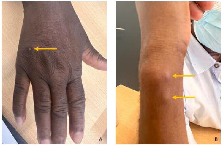 Tuberculose cutânea: um caso clínico