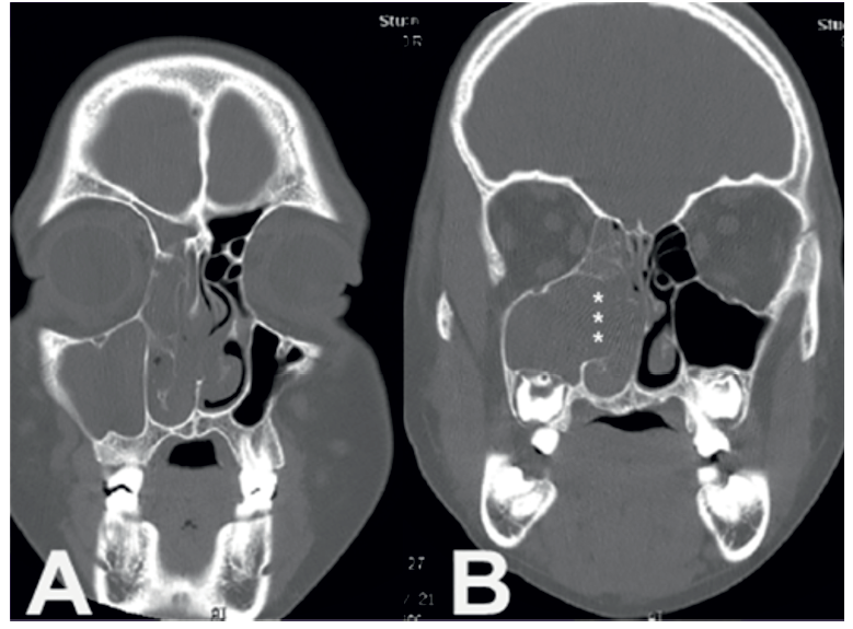 Clinical assessment of sinonasal papillomas through a correlative ...