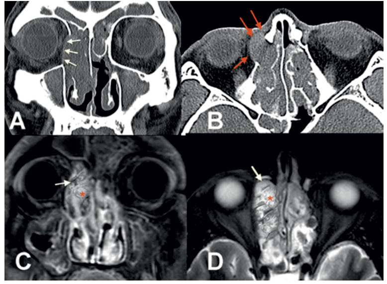 Clinical assessment of sinonasal papillomas through a correlative ...