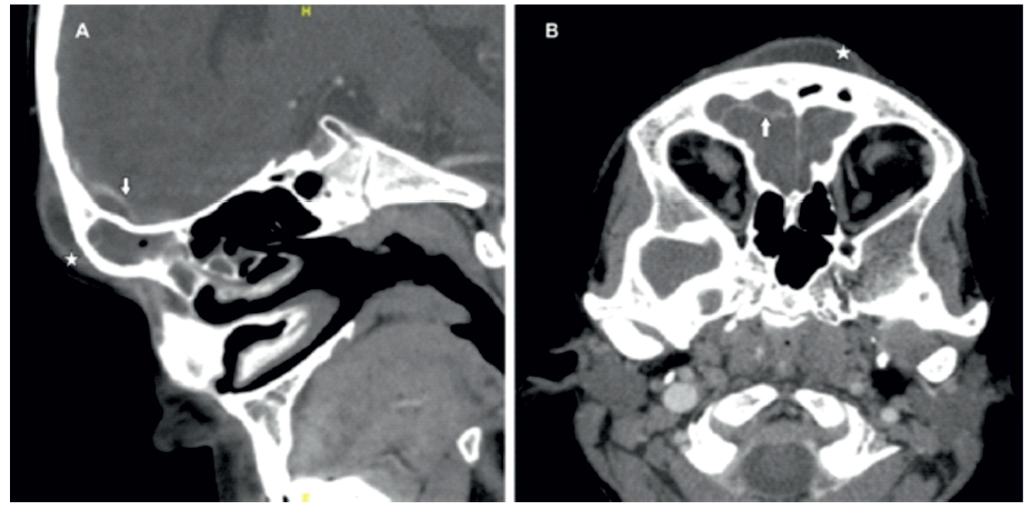 Pott’s puffy tumor and epidural empyema in a pediatric patient
