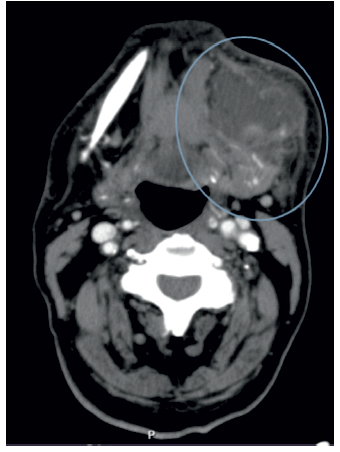 Submandibular abscess caused by Listeria monocytogenes: report of a ...