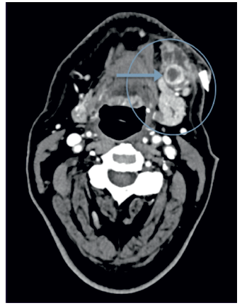 Submandibular abscess caused by Listeria monocytogenes: report of a ...