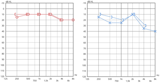 Corrective saccades with normal VOR gain in vestibular schwannoma