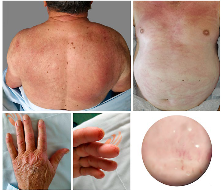 A Case of Rash with Flagellate Erythema and Muscle Weakness: Another ...