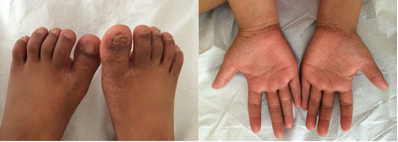 Dyskeratosis Congenita and Short Telomeres in a Female Patient