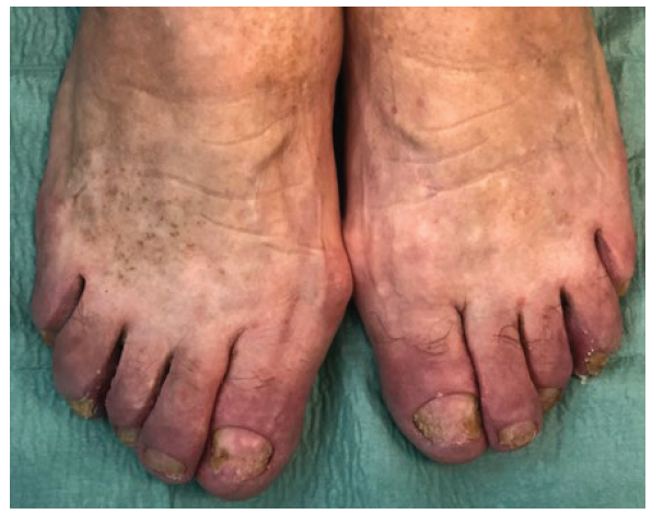 Exuberant Nail Dystrophy as a Presenting Sign of Psoriasis