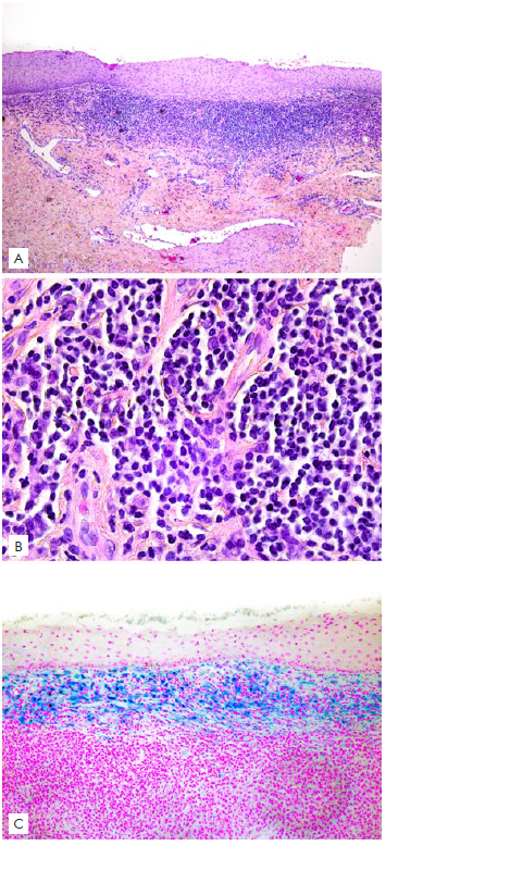 Zoon Balanitis and Lichen Sclerosus: An Uncommon Association