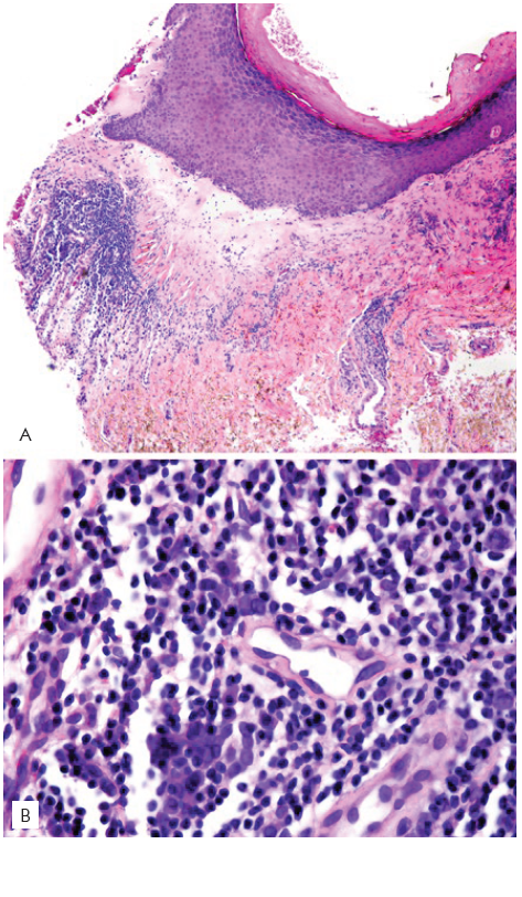 Zoon Balanitis and Lichen Sclerosus: An Uncommon Association