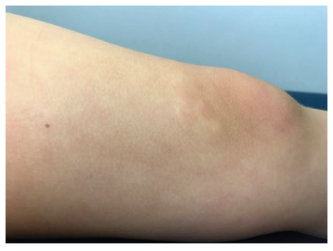 Asymptomatic Nodules in a Child